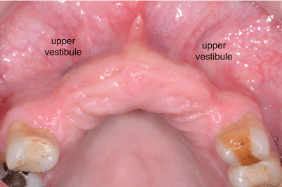 Vestibule and Cheeks | SpringerLink
