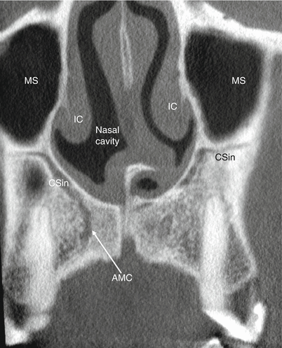 Infraorbital Region | SpringerLink