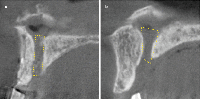 Nasopalatine Canal | SpringerLink