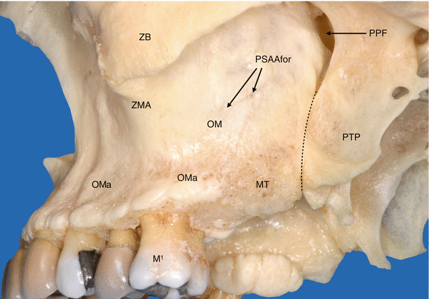 Posterior Maxilla | SpringerLink