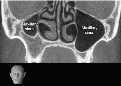 Maxillary Sinus | SpringerLink