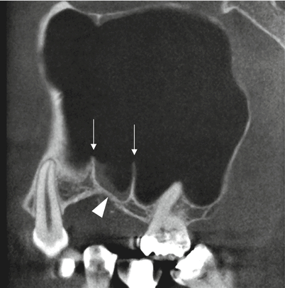 Maxillary Sinus | SpringerLink