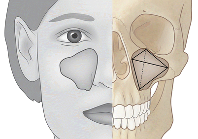 Maxillary Sinus | SpringerLink