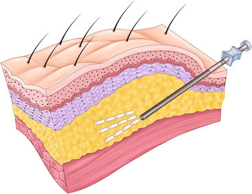 Subcutaneous Testosterone Pellet Insertion | SpringerLink