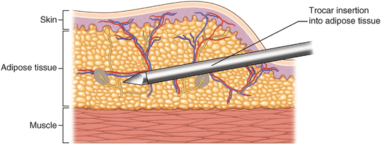 Subcutaneous Testosterone Pellet Insertion | SpringerLink