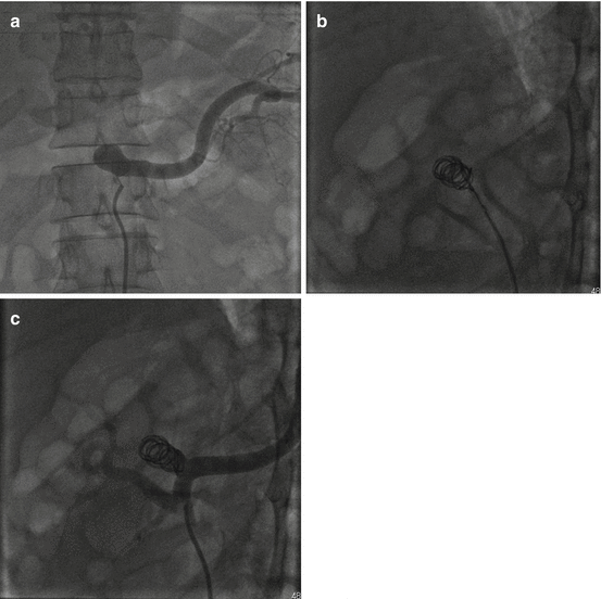 Splenic Artery Embolization for Non-surgical Splenectomy | SpringerLink