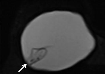 Breast MRI and Implants | SpringerLink