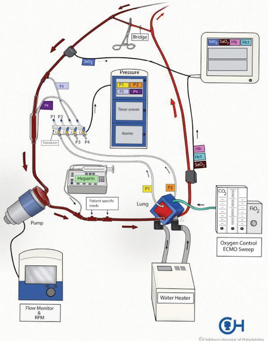 Transfusion Considerations for Neonatal Extracorporeal Membrane ...