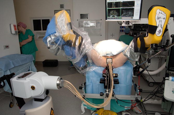 Permanent And High Dose Rate Brachytherapy Technique Indications Results Morbidity