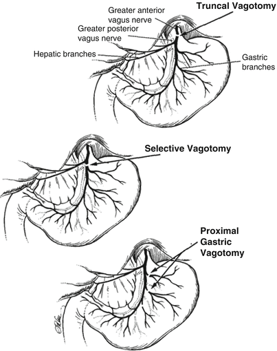 Gastric Outlet Obstruction | SpringerLink