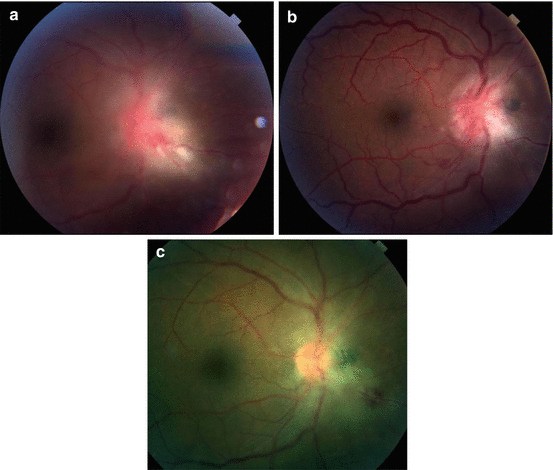 Intraocular Infection | SpringerLink