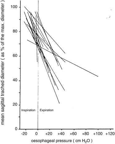 Bronchospasm vs. Bronchoconstriction: A Different View | SpringerLink