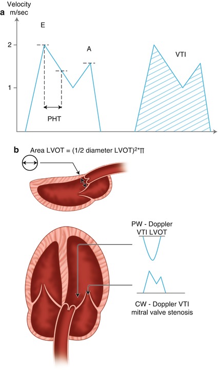 Anomalies of Left Ventricular Inflow and Mitral Valve | SpringerLink