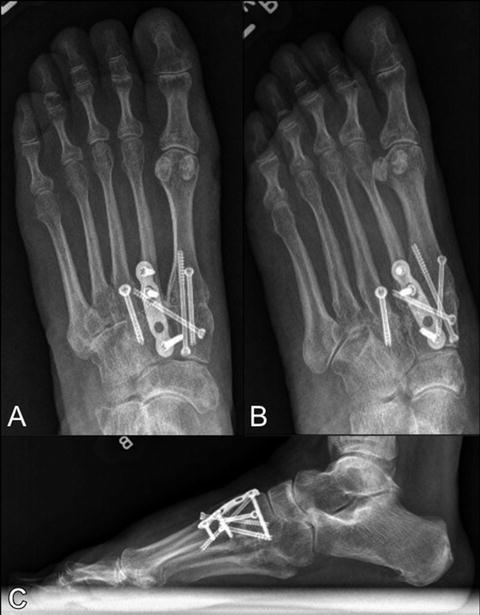 Tarsometatarsal Arthrodesis | SpringerLink