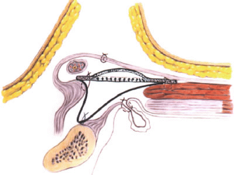 Lichtenstein Tension-Free Hernioplasty | SpringerLink