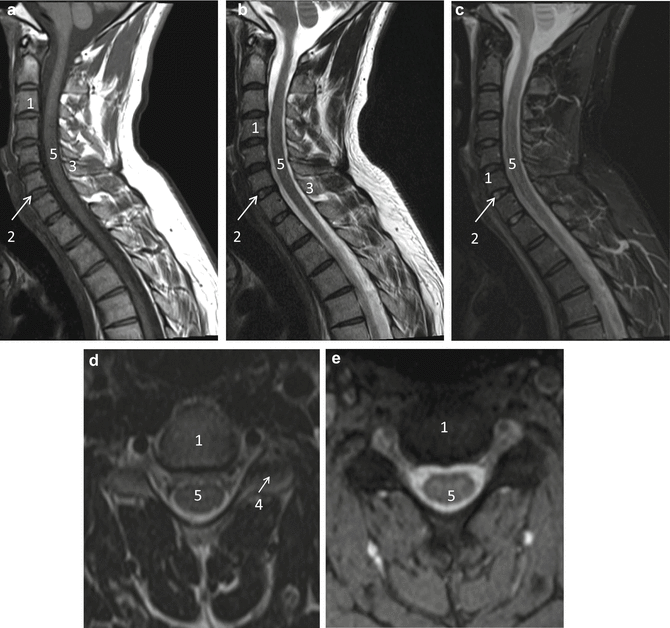 Cervical Spine Imaging: Normal Anatomy and Degenerative Disease ...