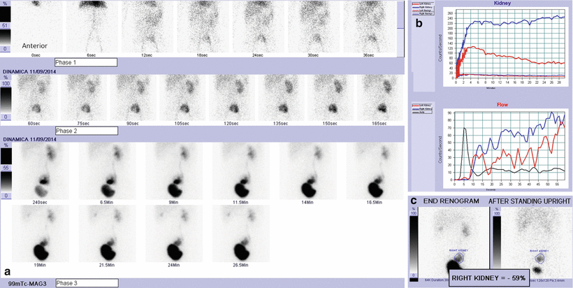 Hydronephrosis | SpringerLink