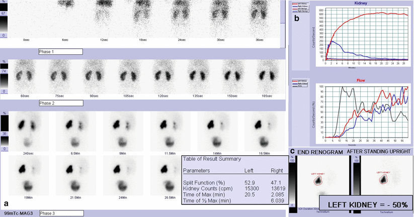 Hydronephrosis | SpringerLink