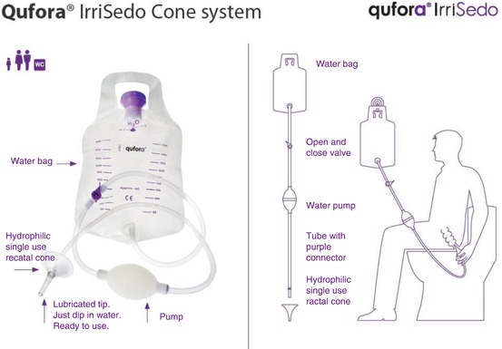 Rectal Irrigation | SpringerLink