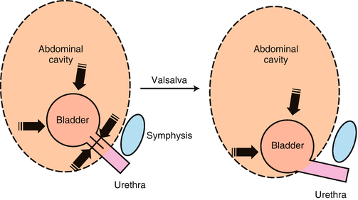 Female Stress Urinary Incontinence | SpringerLink