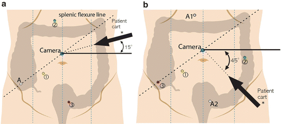 Robotic Low Anterior Resection of Rectal Cancer | SpringerLink