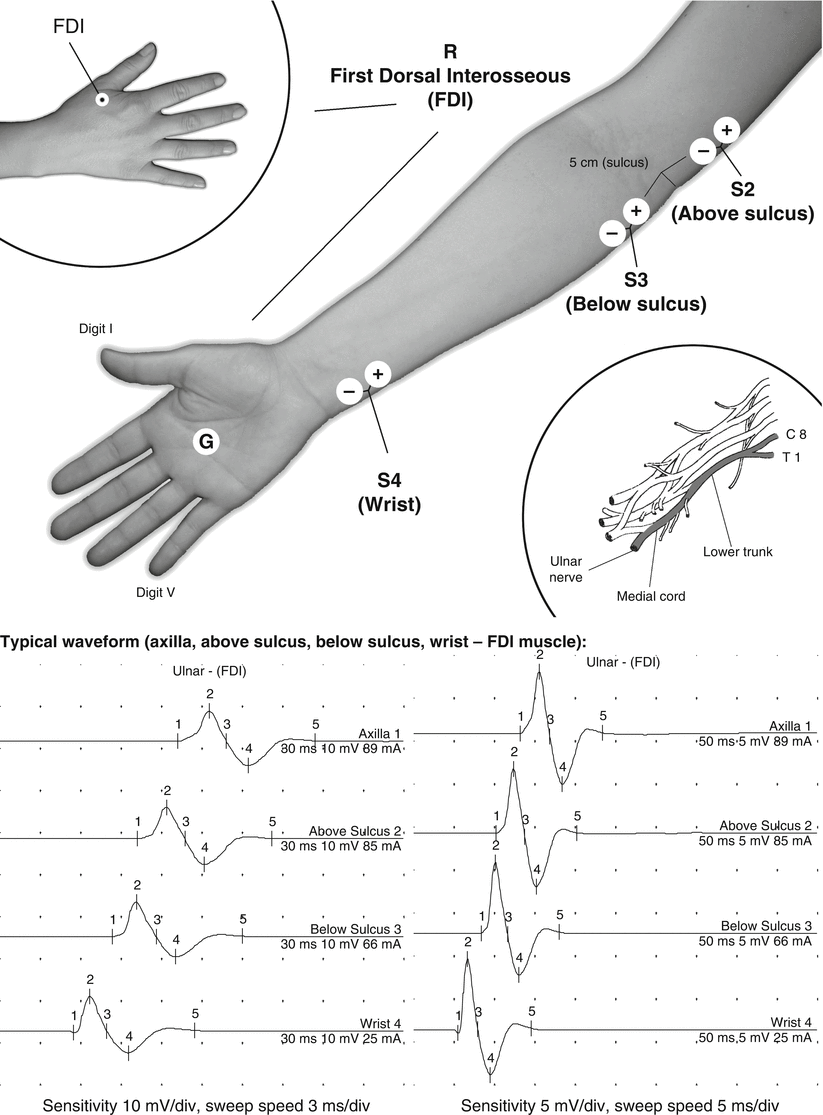 Axilla, Above Sulcus, Below Sulcus, Wrist – Hand; Above Sulcus ...