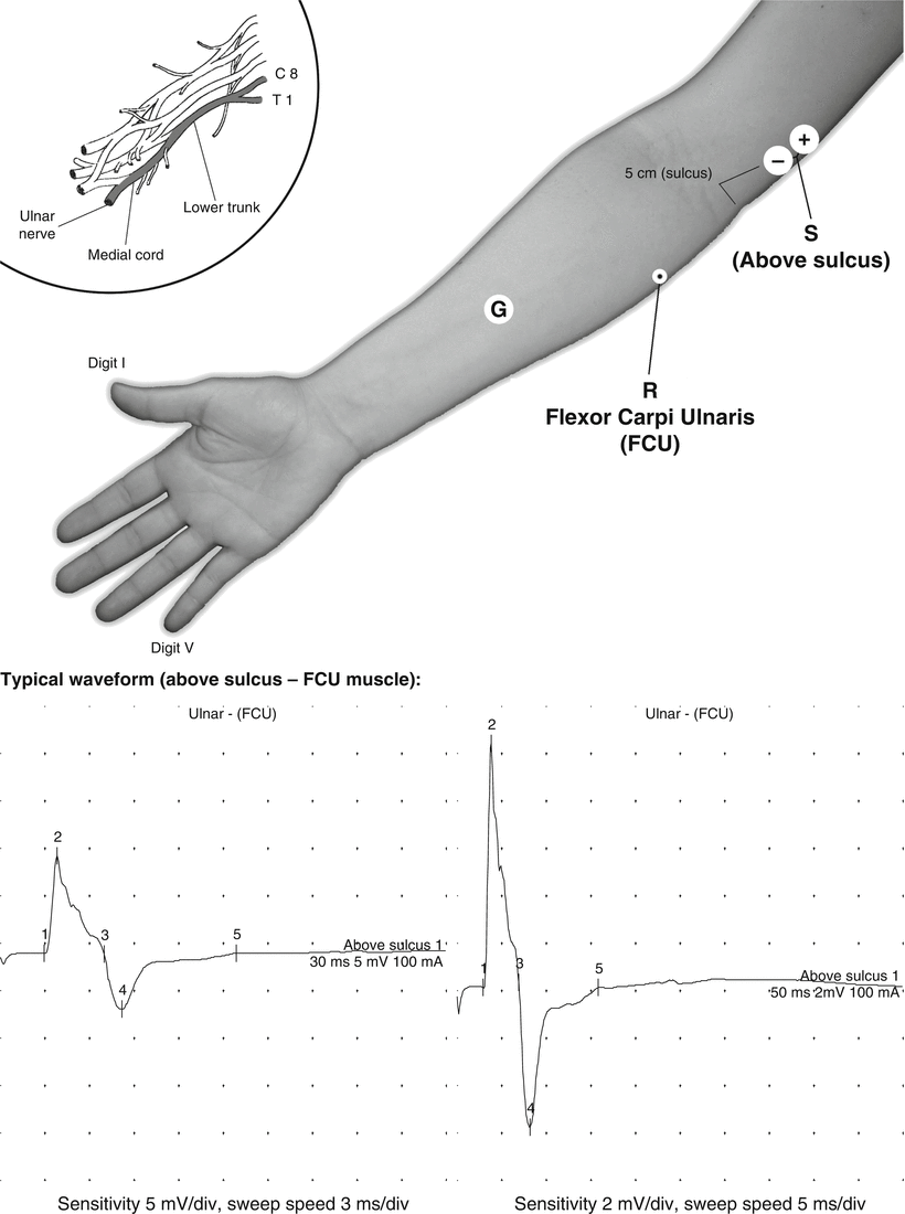 Axilla, Above Sulcus, Below Sulcus, Wrist – Hand; Above Sulcus ...