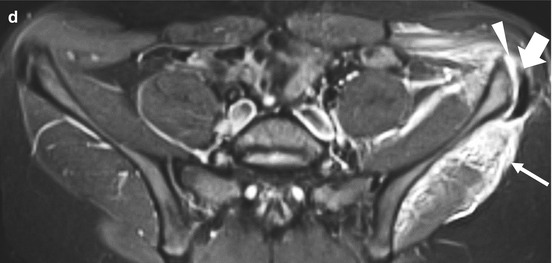 Gluteus Maximus and Surrounding Muscles Injuries | SpringerLink