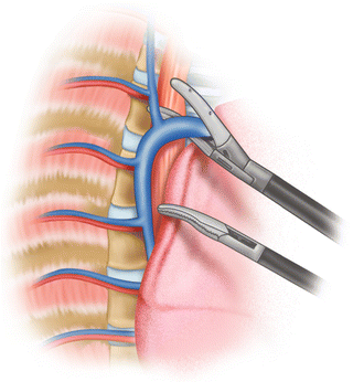 Thoracoscopic Repair of Esophageal Atresia and Tracheoesophageal ...