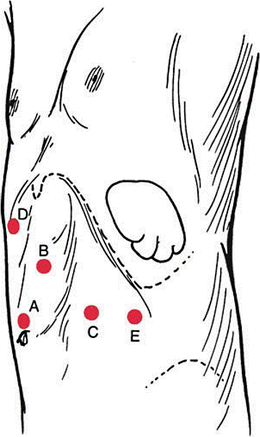 Laparoscopic Splenectomy | SpringerLink