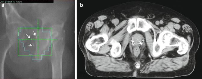 Transrectal Ultrasound | SpringerLink