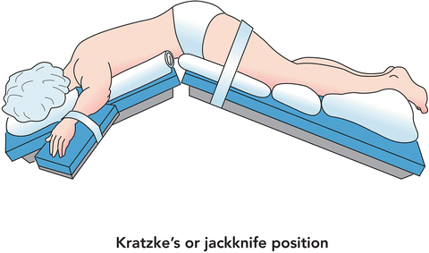 Preventing Perioperative Positioning and Equipment Injuries | SpringerLink