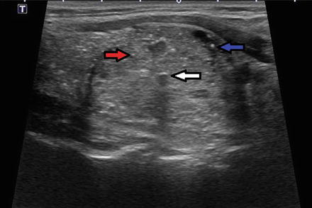 Feature Illustration: Hyperechoic Foci and Calcifications | SpringerLink