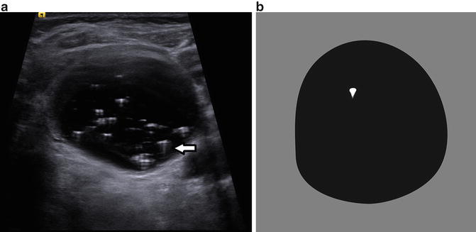 Feature Illustration: Hyperechoic Foci and Calcifications | SpringerLink