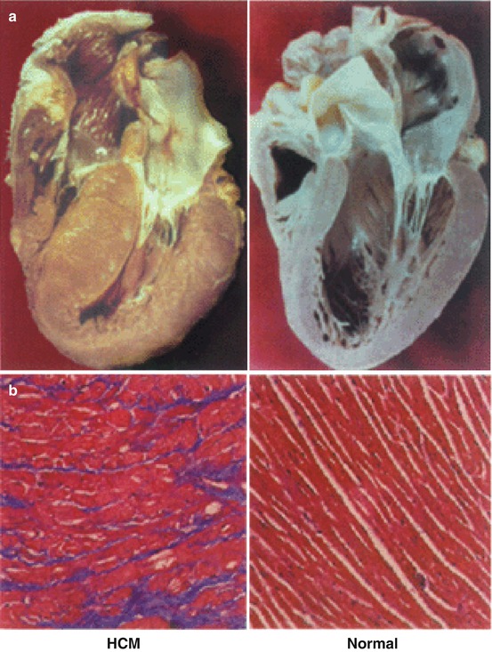 Hypertrophic Cardiomyopathy | SpringerLink