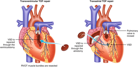 Tetralogy of Fallot | SpringerLink