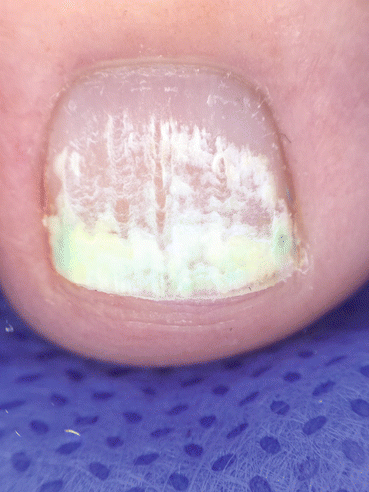 White Superficial Onychomycosis | SpringerLink