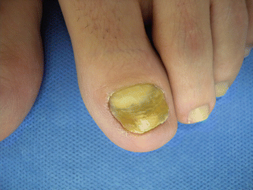 Proximal Subungual Onychomycosis | SpringerLink