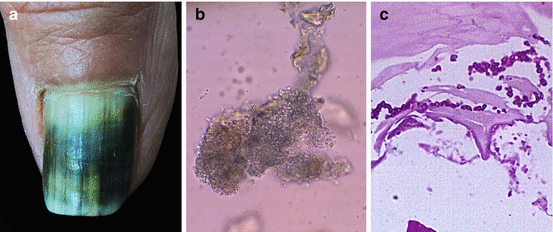 Pigmented Onychomycosis (Fungal Melanonychia) | SpringerLink