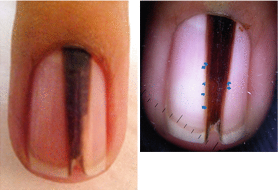 Dermoscopy of the Nail Plate, Nail Matrix, and Nail Bed | SpringerLink