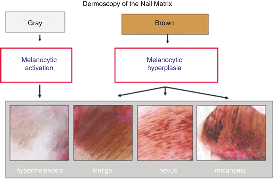 Dermoscopy of the Nail Plate, Nail Matrix, and Nail Bed | SpringerLink