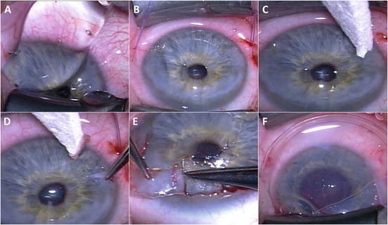 Removal of Salzmann’s Nodule and Amniotic Membrane Placement | SpringerLink