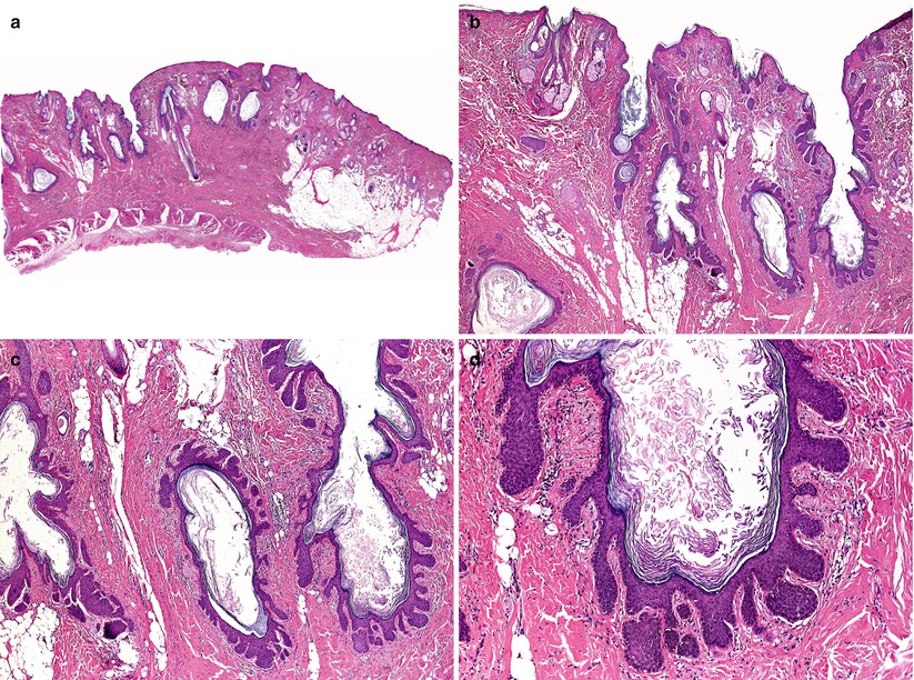 Nevus Comedonicus | SpringerLink