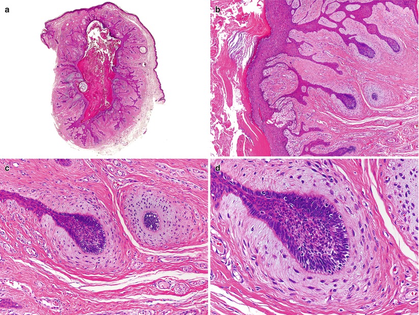 Trichofolliculoma | SpringerLink