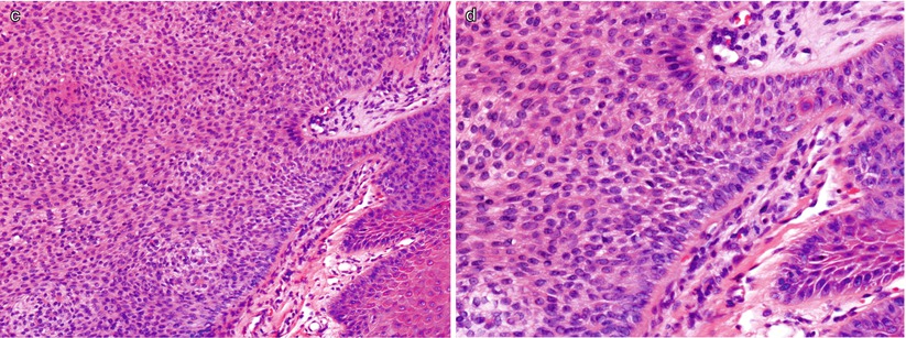 Inverted Follicular Keratosis and Tricholemmoma | SpringerLink