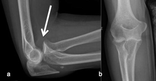 Transolecranon Fracture-Dislocations | SpringerLink