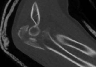 Transolecranon Fracture-Dislocations | SpringerLink