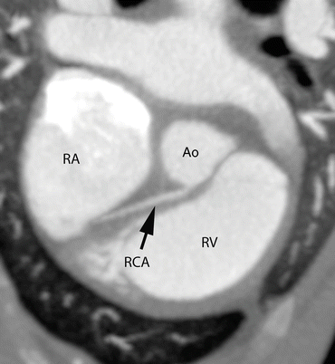 Cardiac CT Angiography | SpringerLink