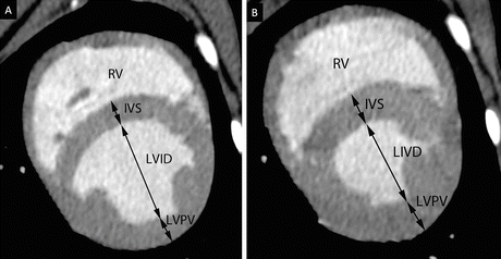 Cardiac CT Angiography | SpringerLink