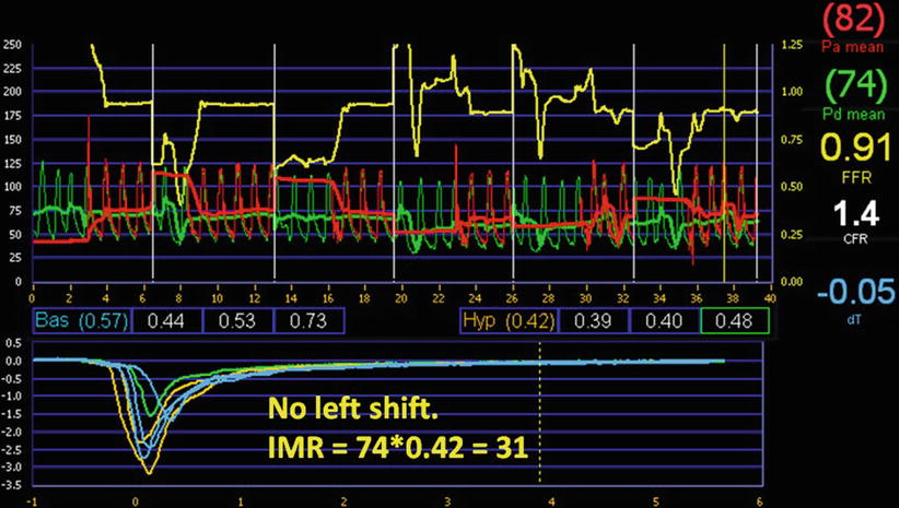 Threshold FFR, Impaired CFR, and IMR: Macrovascular or Microvascular ...